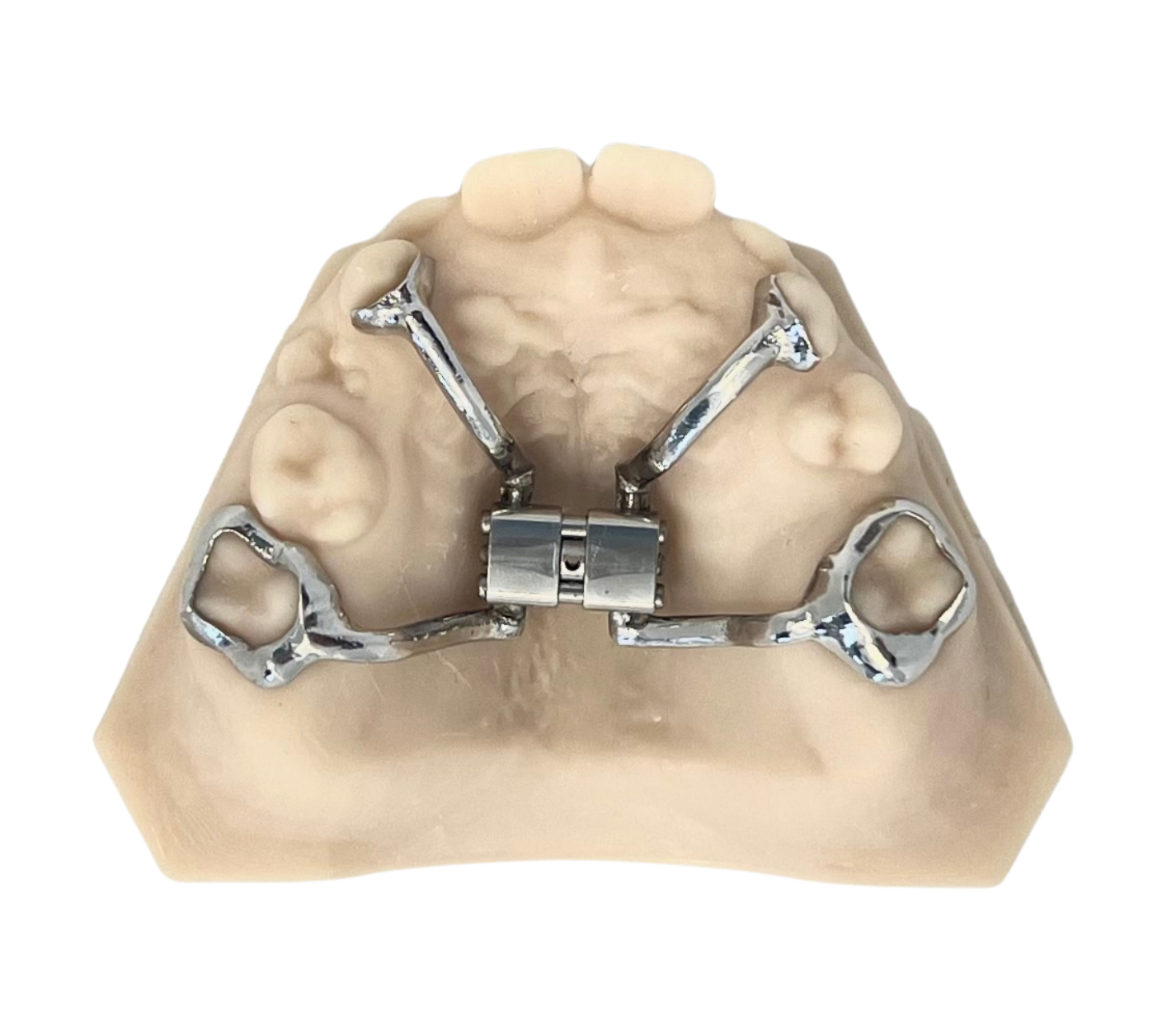 Aparat stały ortodontyczny dla dzieci - OrtoArte