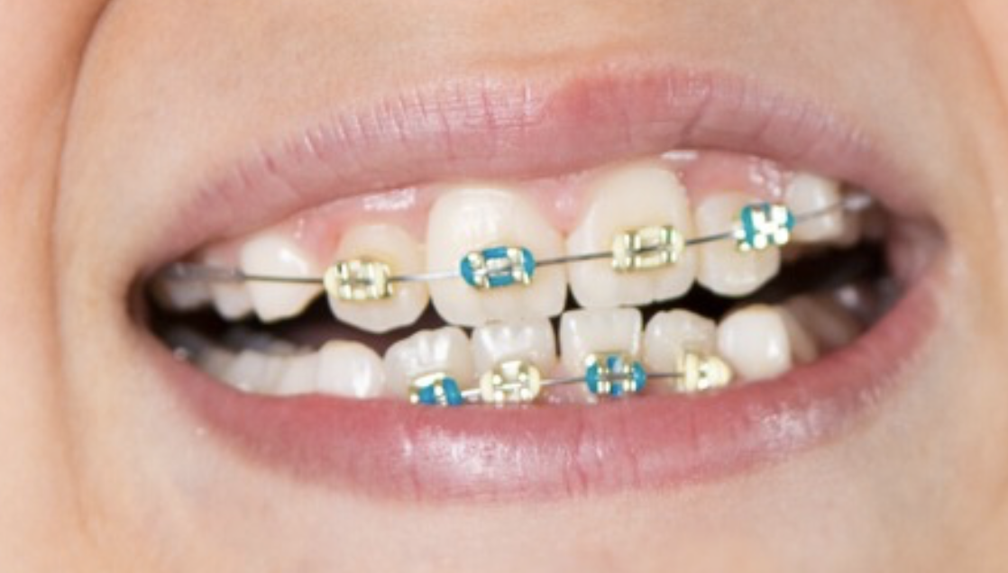 Aparat stały ortodontyczny dla dzieci - OrtoArte